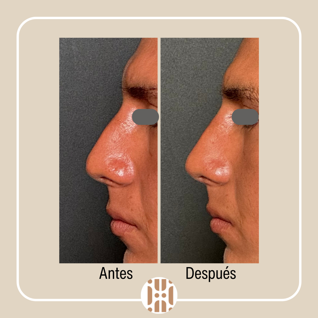 Rinomodelación: mejora tu nariz sin quirófano